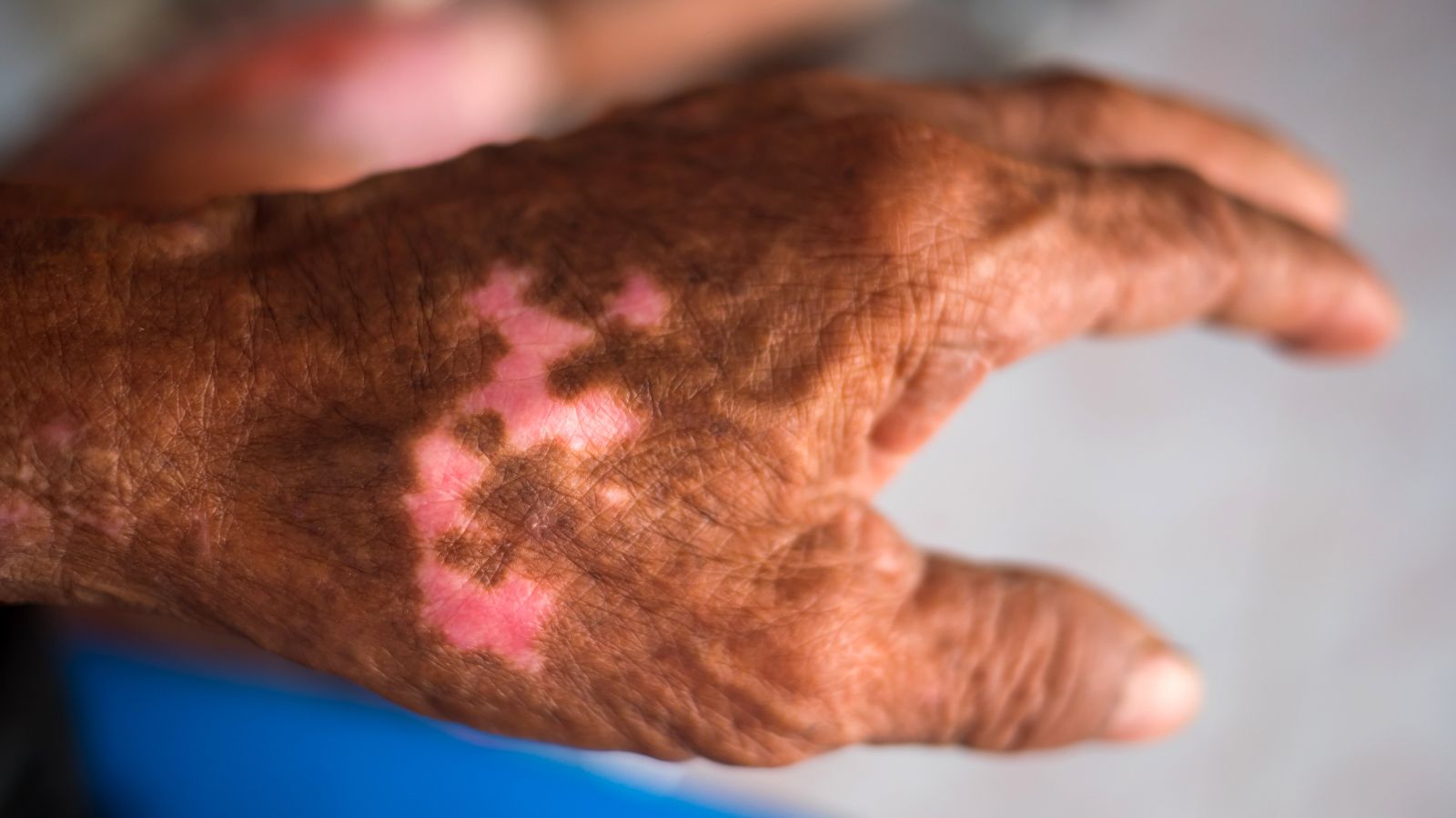Identifying and Treating Common Skin Fungus Infections: An In-Depth ...