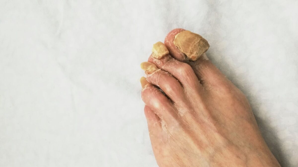 Identifying and Treating Common Skin Fungus Infections: An In-Depth ...