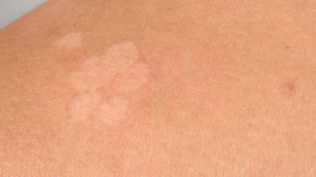 Identifying and Treating Common Skin Fungus Infections: An In-Depth ...