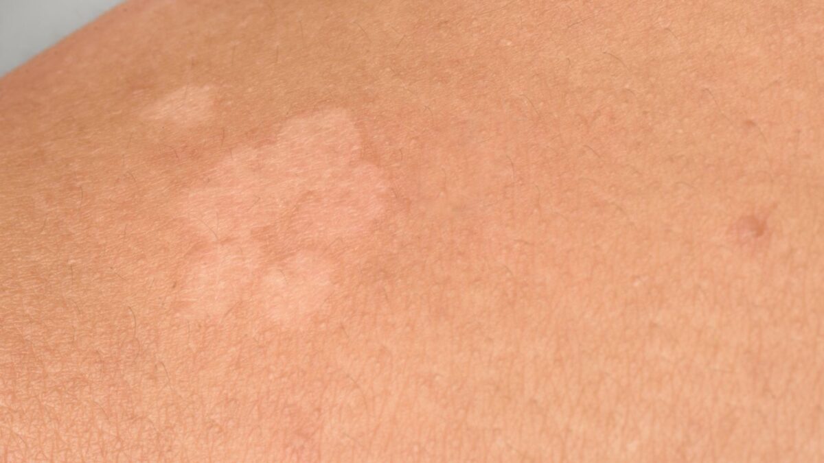 Identifying and Treating Common Skin Fungus Infections: An In-Depth ...